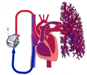 ECMO in Circulatory Failure – Extracorporeal Support and Care - The ...