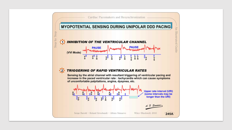 Pacemaker Overview: Device and Electrodes Explained - The Anesthesia Guide