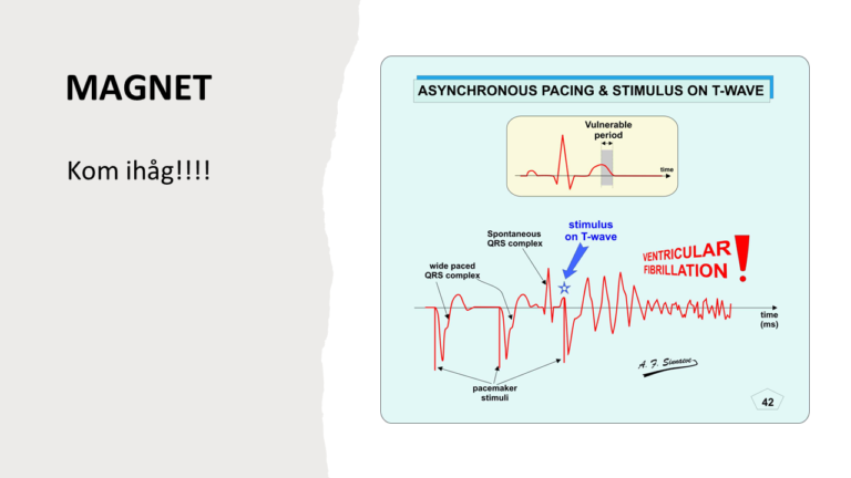 Pacemaker Overview: Device and Electrodes Explained - The Anesthesia Guide