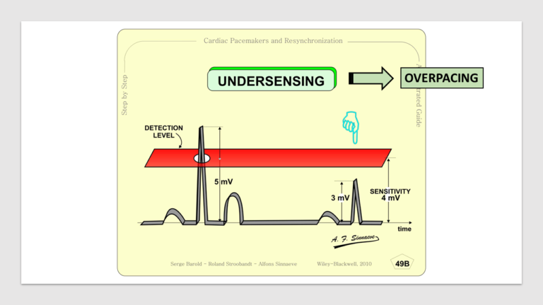 Pacemaker Overview: Device and Electrodes Explained - The Anesthesia Guide