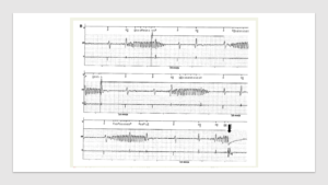 Pacemaker Overview: Device and Electrodes Explained - The Anesthesia Guide