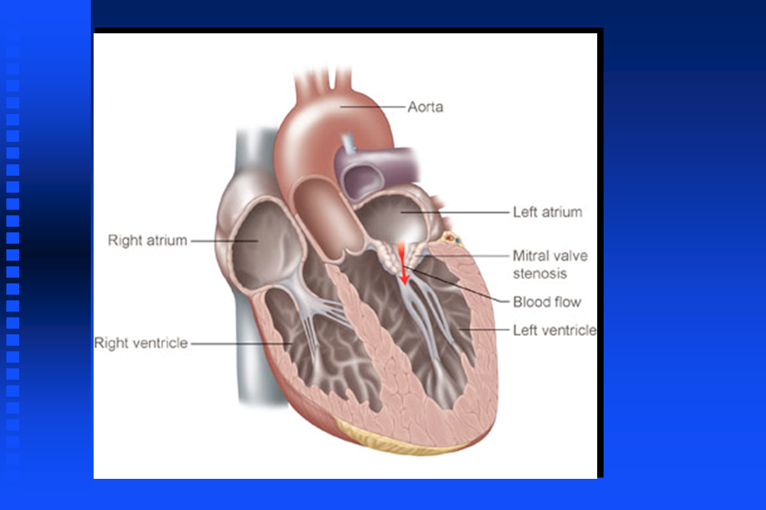 Cardiothoracic Anesthesia for Heart Surgery - GUCH - Pacemaker - The ...