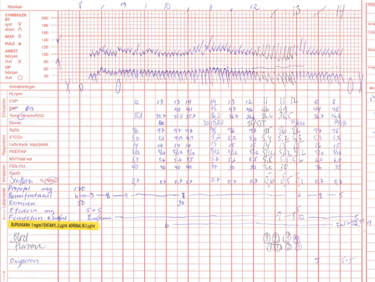 General Anesthesia – Clinical Practice, Safety and Monitoring - The ...
