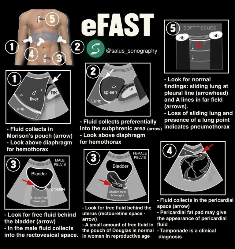 Abdominal ultrasound – eFAST – method, indications and interpretation ...
