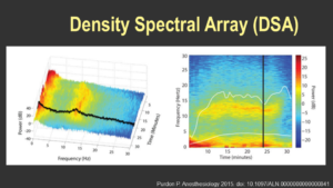 Anesthesia depth monitoring – BIS, SED-line and Entropy in anesthesia ...