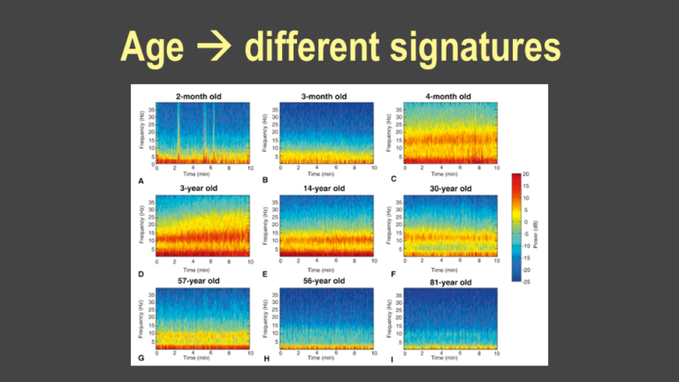 Anesthesia depth monitoring – BIS, SED-line and Entropy in anesthesia ...