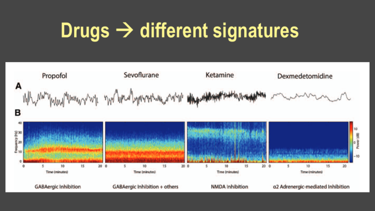 Anesthesia depth monitoring – BIS, SED-line and Entropy in anesthesia ...