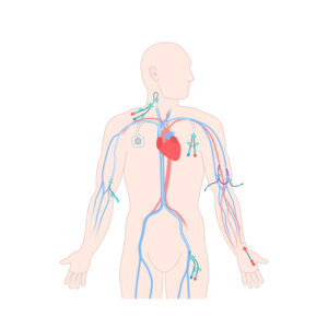 Central venous catheter – CVC insertion – indications, technique and ...