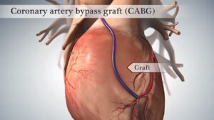 Cardiothoracic Anesthesia for Heart Surgery - GUCH - Pacemaker - The ...