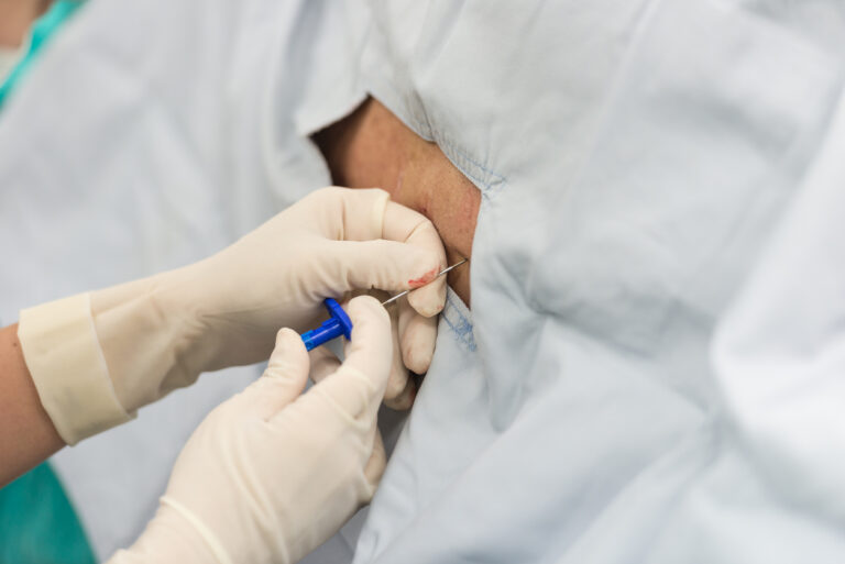 Epidural anesthesia – technique, indications and clinical use (EA ...