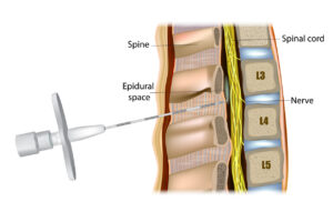 Epidural anesthesia – technique, indications and clinical use (EA ...