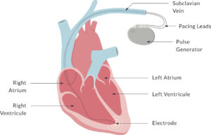 Pacemaker Overview: Device and Electrodes Explained - The Anesthesia Guide