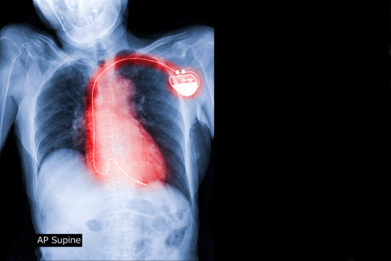 Pacemaker Overview: Device and Electrodes Explained - The Anesthesia Guide