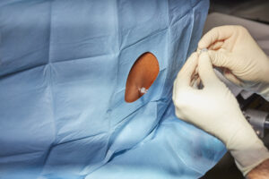Spinal anesthesia – technique, indications and clinical use - The ...