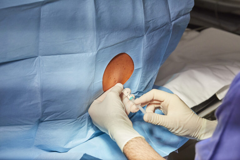 Spinal anesthesia – technique, indications and clinical use - The ...