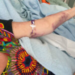 Midline (RIC Line, Certofix) – Technique, Use and Safety - The ...