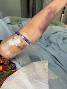 Midline (RIC Line, Certofix) – Technique, Use and Safety - The ...