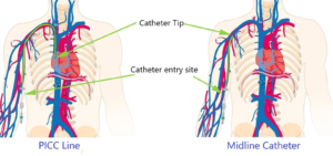 Central Venous Catheter English - The Anesthesia Guide
