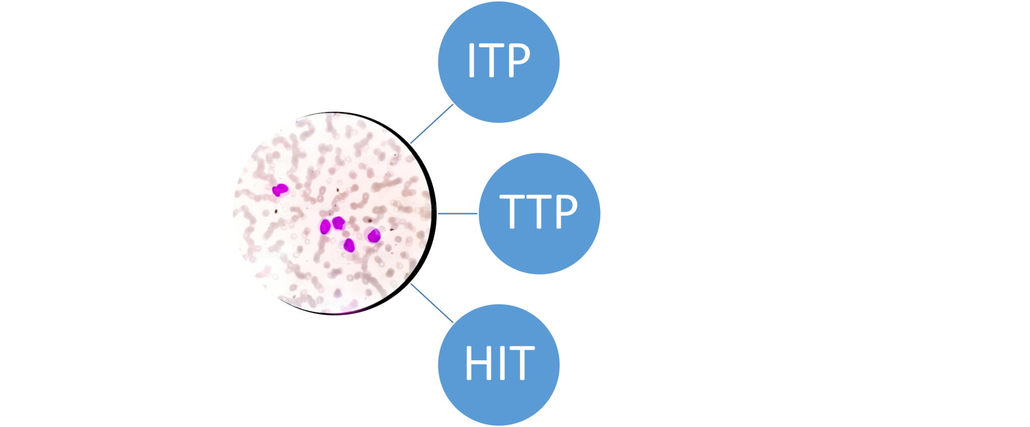 Thrombocytopenia – Diagnosis and Treatment of ITP, TTP and HIT - The ...