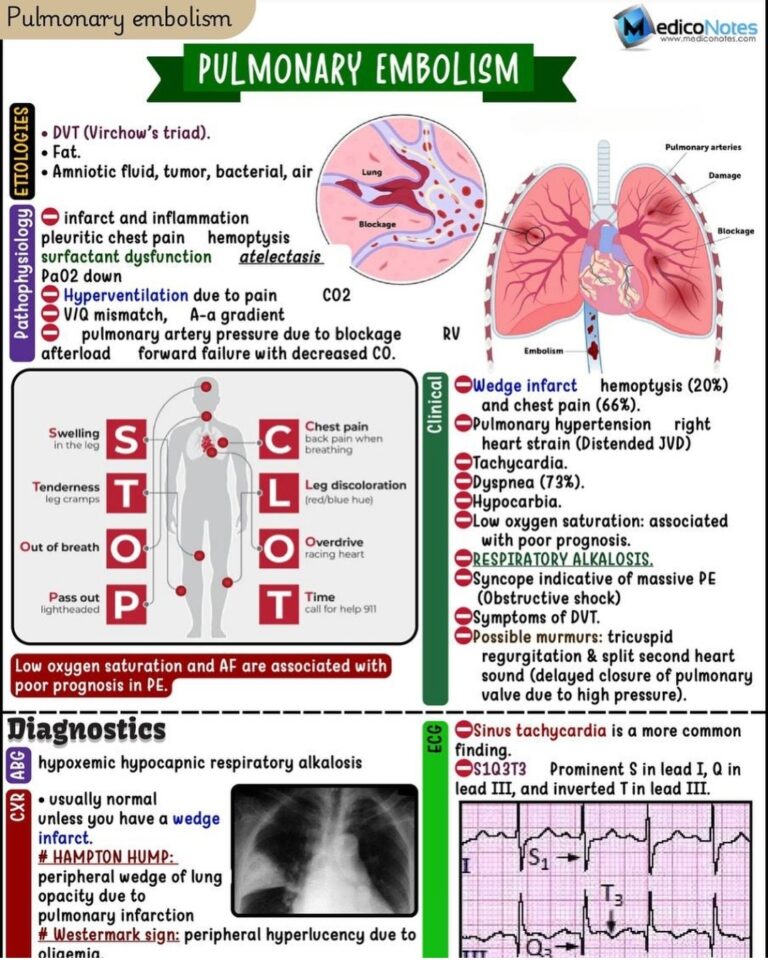 Pulmonary Embolism – Acute Management and Clinical Guidelines - The ...